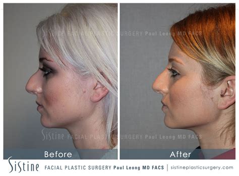 Plastic Surgery Before And After Nose Jobs