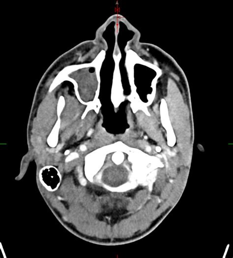 Post Influenza Fusobacterium Infection A Rare Cause Of Jaundice Shm Abstracts Society Of