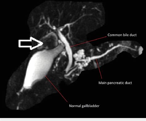 Mrcp With An Arrow Pointing To The Duplicated Gallbladder Emanating Download Scientific Diagram