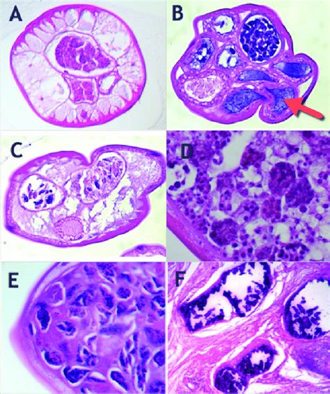 Filariasis Histology