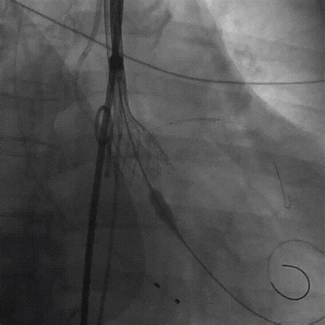 嘉境 · 瓣旅｜佛山市南海区人民医院成功使用tauruselite完成一例冠脉高风险经导管主动脉瓣膜置换术 严道医声网