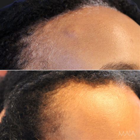Osteoma Removal Maia Plastic Surgery
