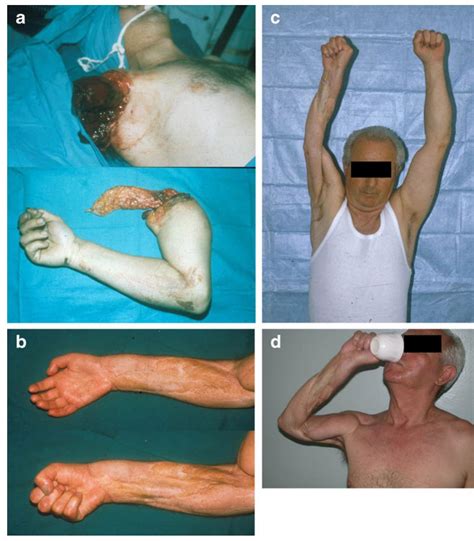 Figure 1 Current Management Of The Mangled Upper Extremity