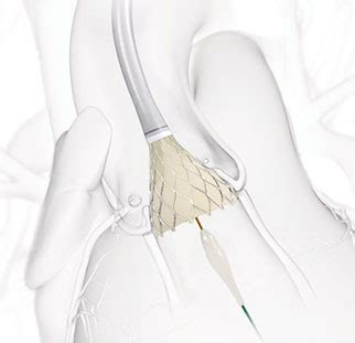Acc 2017 Corevalve Non Inferior To Surgery In Intermediate Risk