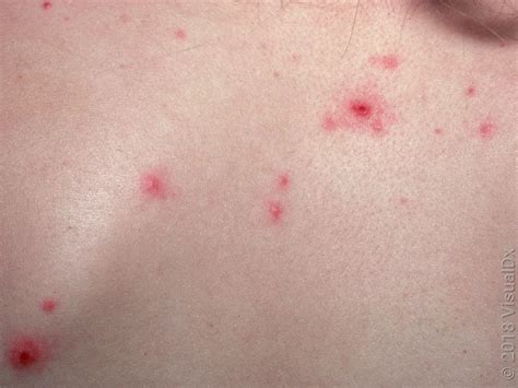 Chickenpox Vs Bug Bites How To Tell The Difference Goodrx