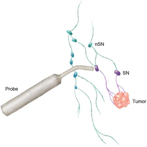 Sentinel Node Detection Schematic Illustration Of Intraoperative