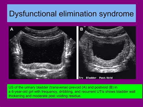 Pediatric Urinary Tract Infectionthe Role Of Imaging Pdf