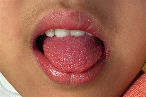 Streptococcus Bacterial Infection