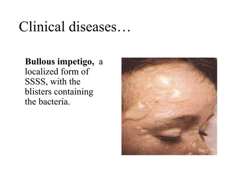 Staphylococcus Aureus2013ppt