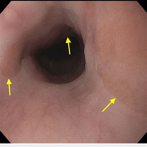 Upper Endoscopy Demonstrated An Associated Stricture And Additional