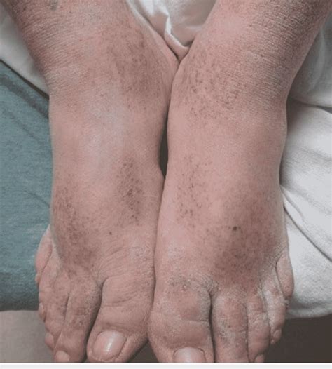 Petechiae Along The Dorsal Surfaces Of The Feet And Anterior Ankles