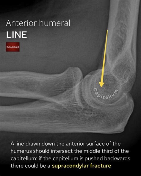 How To Read An Elbow X Ray Anatomy And Alignment Guide
