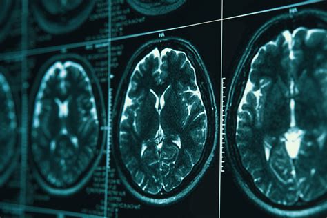 Terri Schiavo Brain