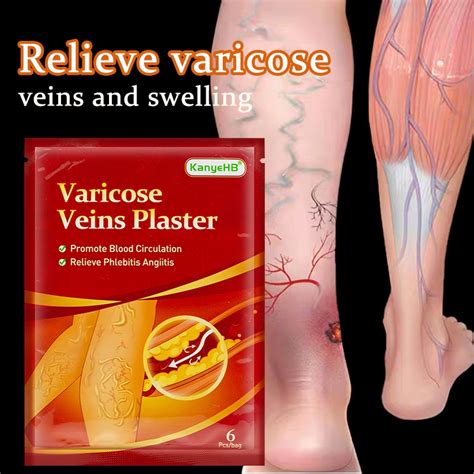 Varicose Veins Patch Varicose Veins Ointmnet Vasculitis Phlebitis Spider Cream Varicosity