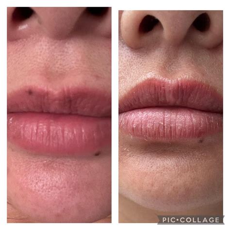 Lip Blushing Mole Upper Lip Rmicroblading