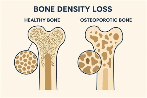 Understanding Bone Density Loss Healthy Vs Osteoporotic Bone