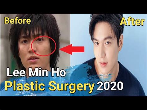 Lee Min Ho Plastic Surgery Before And After