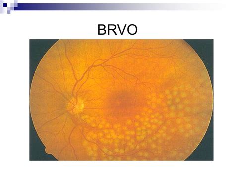 Hemi Central Retinal Vein Occlusion Ppt Video Online Download