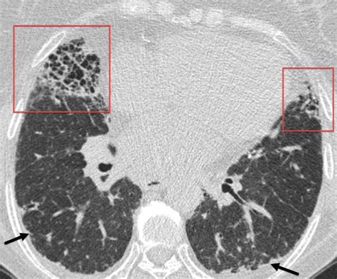 A 53 Year Old Female Patient With A Diagnosis Of Rheumatoid Arthritis
