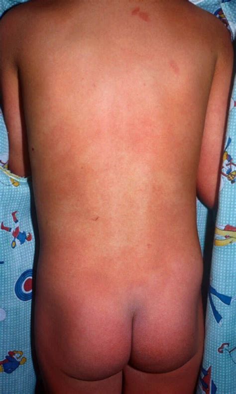 Poze Medicale Stafilococul Auriu Si Alte Infectii Stafilococice