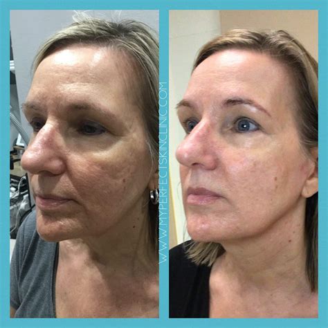 Anti Aging Facials And Treatments In Gilbert Az