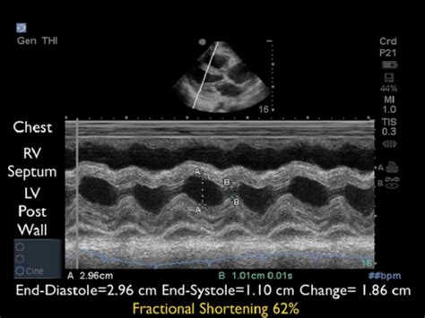 Ejection Fraction Echo At Michael Holcomb Blog