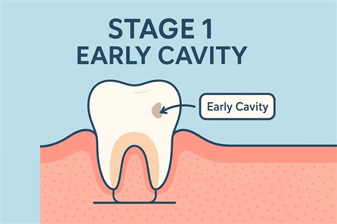Stage 1 Early Cavity What It Is And How To Treat It