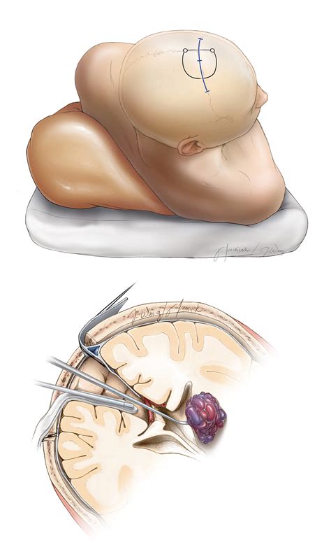 Deep Cerebral Cavernous Malformation The Neurosurgical Atlas