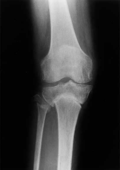 An Example Of Postoperative Radiograph The Fibular Head Is Morselized Download Scientific