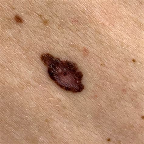 Nodular Melanoma Mole Melanoma Vs Mole Differences And When To Seek