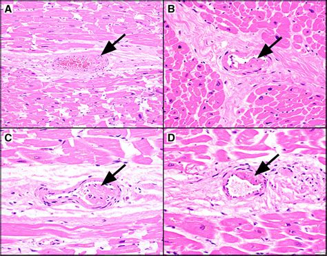Covid 19associated Nonocclusive Fibrin Microthrombi In The Heart