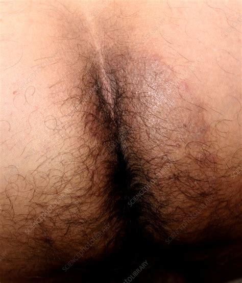 Ringworm Fungal Infection Of The Buttocks Stock Image C037 2265 Science Photo Library