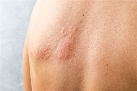 Shingles Vaccine Facts And Side Effects
