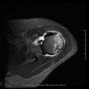 Hill Sachs Defect Radiology Reference Article