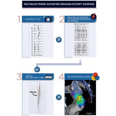 Multielectrode Catheter Induced Ectopy Mapping A Novel Technique For