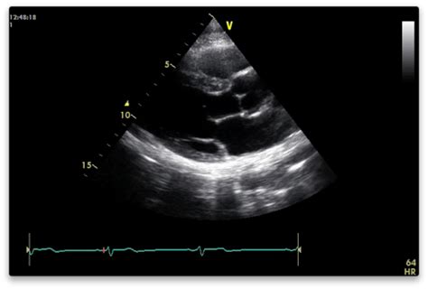 Parasternal Long Axis Plax Critical Care Northampton
