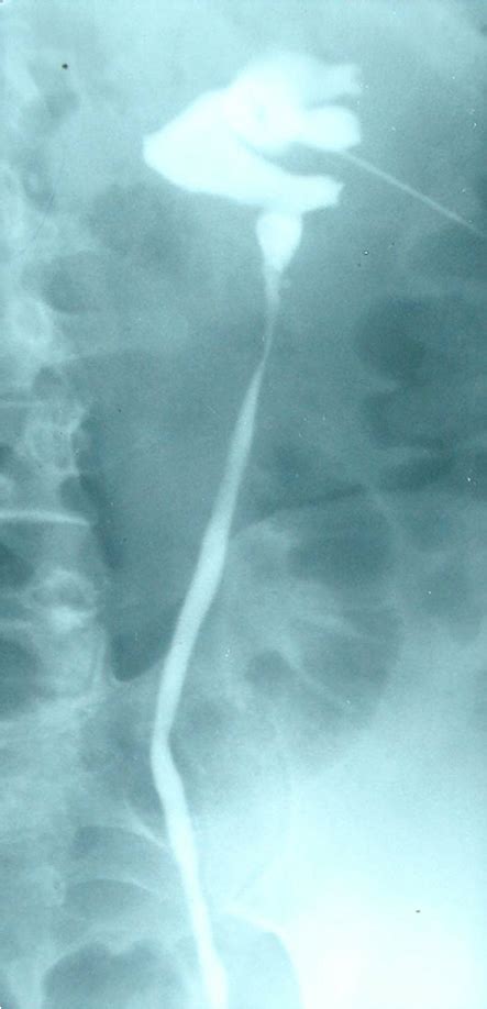Intravenous Contrast Urogram 12 Min Phase Demonstrating Normal