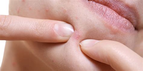 Can Exercise Cause Acne Dermatologist Tips To Prevent Acne Caused By Exercise