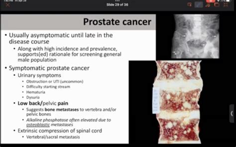 Disorders Involving The Prostate Flashcards Quizlet