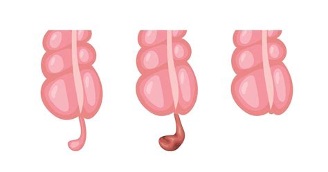 Appendicitis Inflammation Developing In Three Stages From Normal Appendix To Infected Appendix