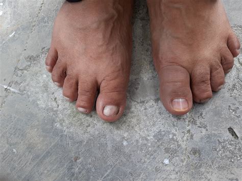 Customized Silicon Great Toe Prosthesis At ₹ 15000piece Kolkata Id