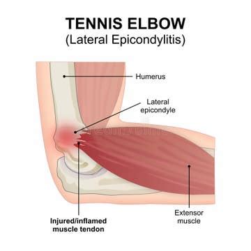 Tennis Elbow Lateral Epicondylitis Flashcard Illustration Stock Image