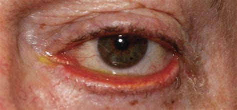 “when Is Dry Eye More Than Just Dry Eye Vancouver Eye Doctor