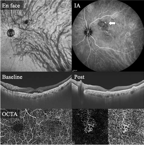 Findings In An 81 Year Old Man With Pcv By Conventional Classification