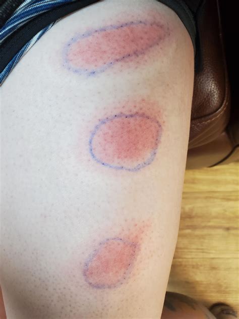 Emgality Dosing New Drug Product Emgality Mpr