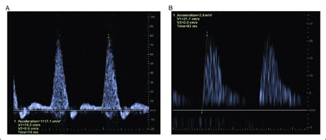 Doppler Waveforms A A Normal Waveform Is Shown Without The Presence