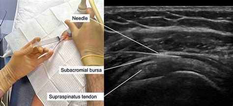 Ultrasound Guided Shoulder Steroid Injection • Ealing And Brentford