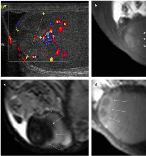 Figure 1 From Segmental Testicular Infarction Role Of Imaging