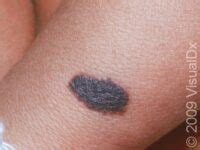 Congenital Melanocytic Nevus Causes Symptoms And Treatment