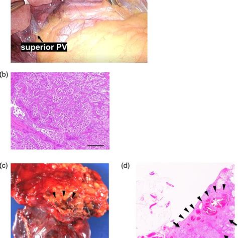 A Thoracoscopic Findings Showed That The Right Upper Lobe Was